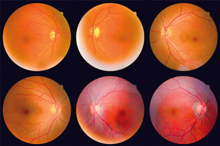 Retina Conditions Melbourne | Retina Disease Treatment Titusville
